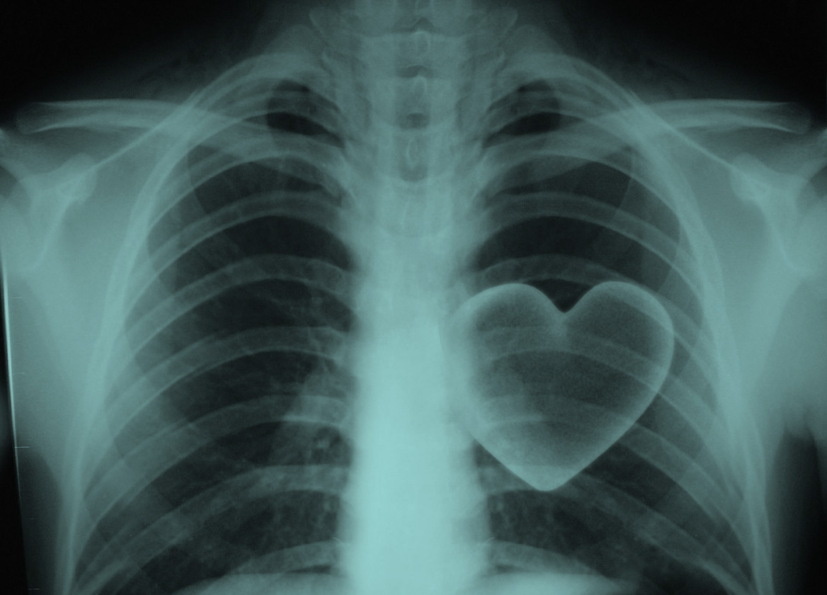 'Plastic heart surgery' sweeps America - The Poke